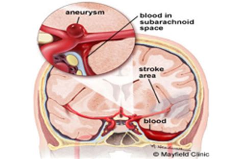 Berry Aneurysm Brain Aneurysm