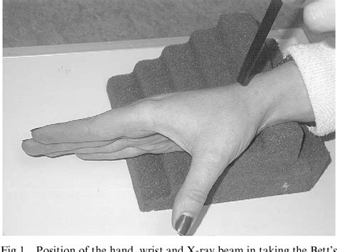 Figure 1 From Radiographic Optimization Of The Eaton Classification Semantic Scholar