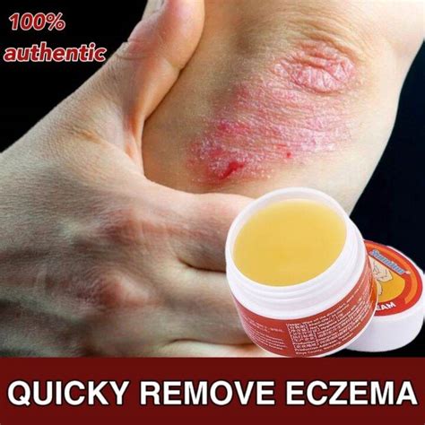 Atoderma Cream Original Gamot Sa Kati Kati Sa Balat Atoderma Creameczema Cream Clotrimazole Anti