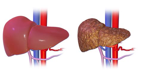 რა სამკურნალო რჩევებს გვაძლევს ხალხური მედიცინა ღვიძლის ციროზის სამკურნალოდ სასარგებლო რჩევები