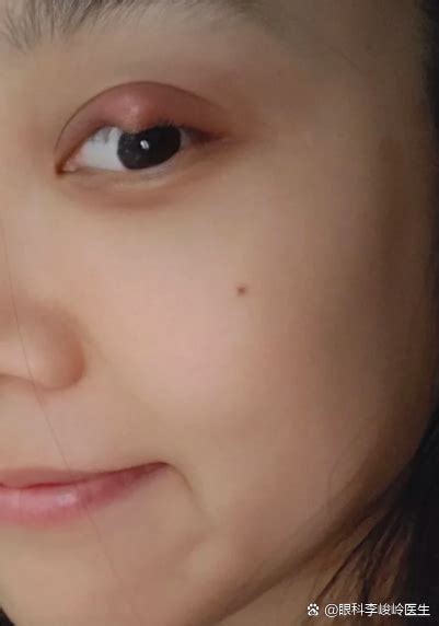 麦粒肿消肿后留一个小包不退咋回事？