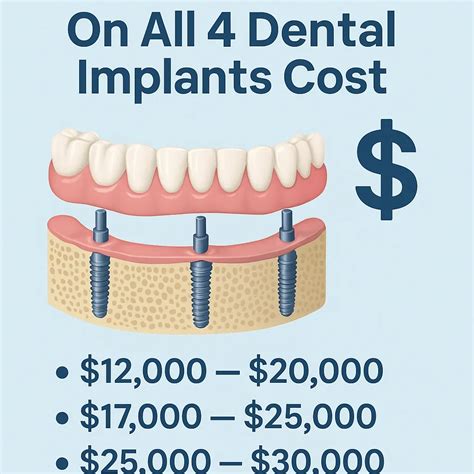 On All 4 Dental Implants Cost Complete 2025 Guide 💎 Redent Clinic