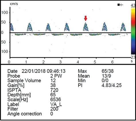 Systolic Flow Reversal In The Left Vertebral Artery At Transcranial Download Scientific Diagram