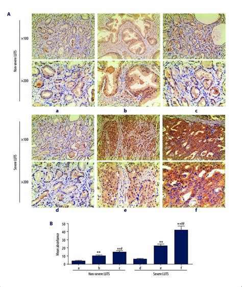 Clusterin Expression In Prostate Tissues A Clusterin Expression In