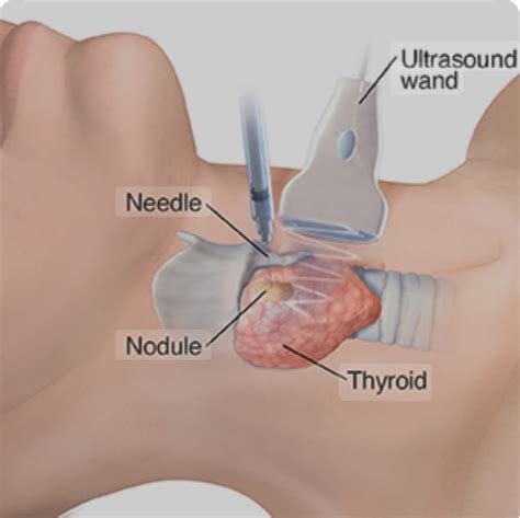 Бамбай булчирхайн хортой болон хоргүй хавдрын үзлэг оношлогоо мэс заслын тусламж үйлчилгээ
