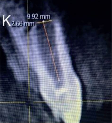 Preoperative Clinical Revascularization Procedure And Radiographic Download Scientific Diagram