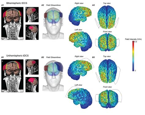 New Paper The Differential Effects Of Unihemispheric And Bihemispheric