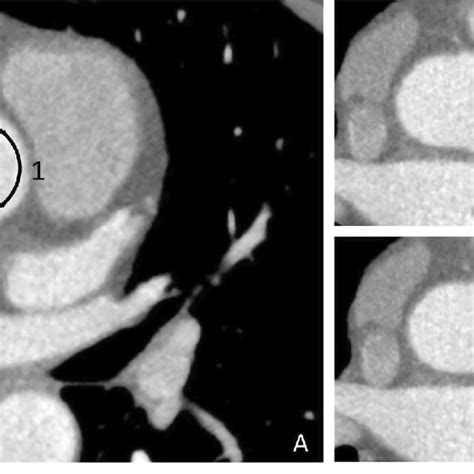 Regions Of Interest Are Manually Drawn In The Aorta A Proximal Lad Download Scientific