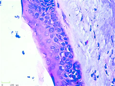 C Absence Of Granular Cell Layer In The Cyst Wall Download