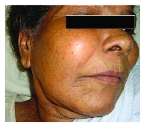 Preoperative Right Cheek Swelling Download Scientific Diagram