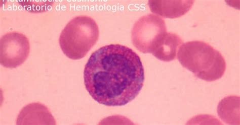 Carlos Hema Uribarri 2020 Mielocito Eosinófilo