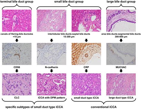 Expert Consensus On Pathological Diagnosis Of Intrahepatic