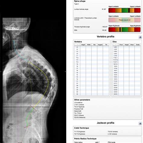 Parameters Of Sagittal Balance Collected Using Keops Software Smaio Download Scientific