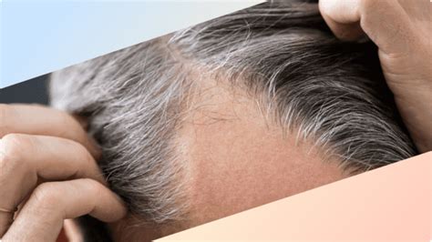 Why Do I Pick At My Scalp Nocd