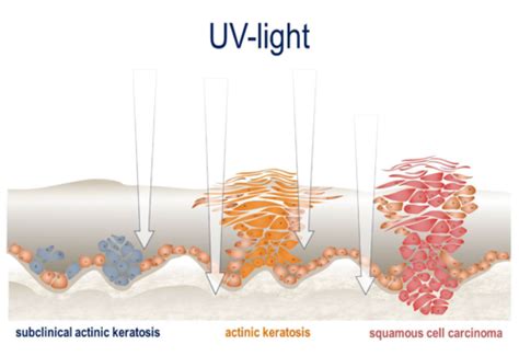 Nur200 Mod3 Inclass Cancer Lecture Flashcards Quizlet