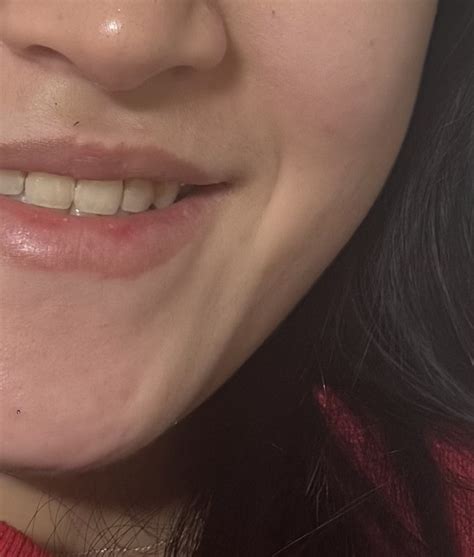 의사에게 물어보세요 제가 하관이 길어서 강남언니 1등 성형수술and피부시술 정보앱