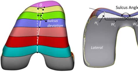 Journal Of Arthroplasty On Linkedin There Is More Consistency In Trochlear Morphology Of