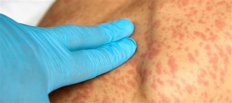 Comparison Of 5 Mg Vs 10 Mg Droperidol In Managing Agitation In Ed