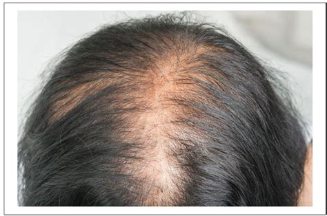 Diffuse Alopecia Photo Courtesy Of Srisakorn Adobe Stock