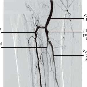 Popliteal Artery And Bifurcation Into A Diseased Anterior Tibial Artery Download Scientific