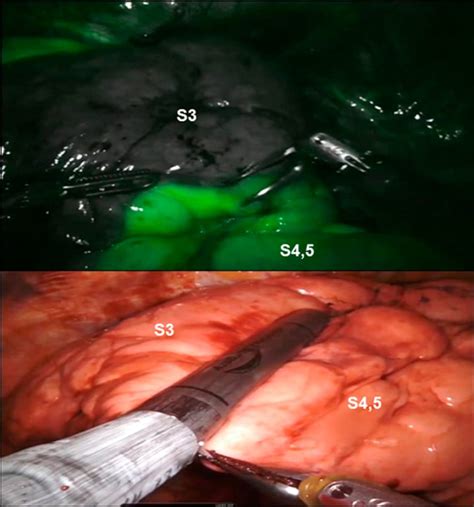 The Technique Of Robotic Anatomic Pulmonary Segmentectomy Ii Left Sided Segments
