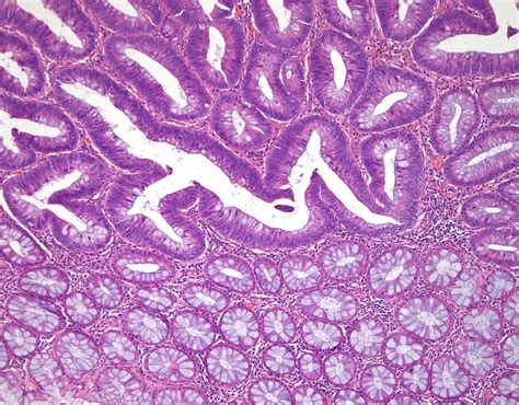 Tubular Colon Polyp Light Micrograph Stock Image C038 9542 Science Photo Library