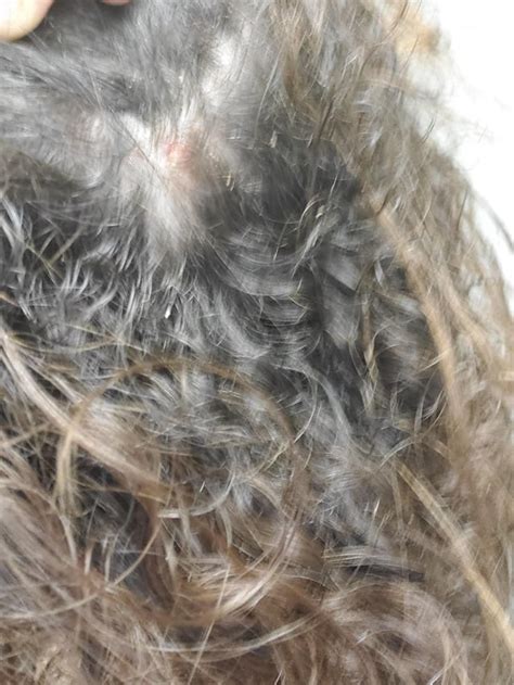 Scalp Patches Bald Spots Crusties And Dandruff R Psoriasis