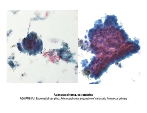 Glandular Lesions Cytology In Cervical Cytology Pdf