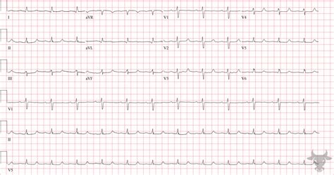 Hypocalcemia Ecg Stampede