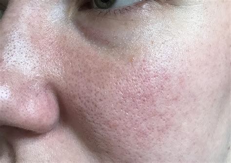 Large Pores On Cheeks Causes