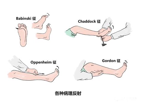 危重症患者的神经系统检查（手绘） 脑医汇