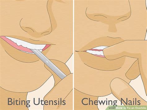 7 Ways To Fix An Overbite WikiHow