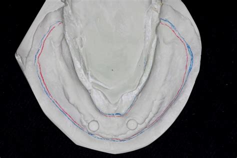 Boise Idaho Prosthodontics Edentulous Custom Tray For Pvs Impression Fabrication