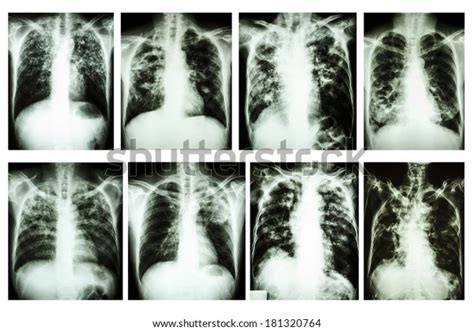 Collection Chest Xray Pulmonary Tuberculosis Stock Photo Shutterstock