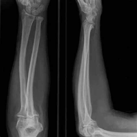 Lntraoperative Photo Note The Ulnar Metaphysis Introduced In The Download Scientific Diagram