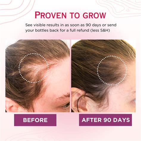 Redrestore Dht Blocker For Women