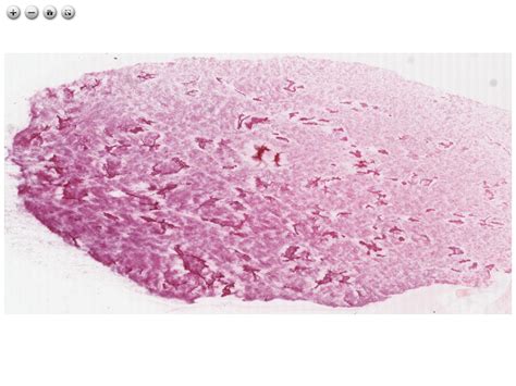 55 Glioma Histopathology Atlas