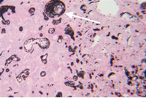 Onyx Liquid Embolic System Semantic Scholar