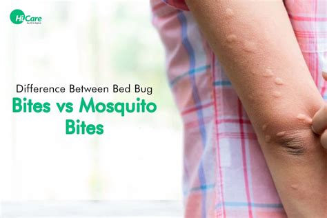 Are Bed Bug Bites Bigger Than Flea Bites At Martha Cannon Blog