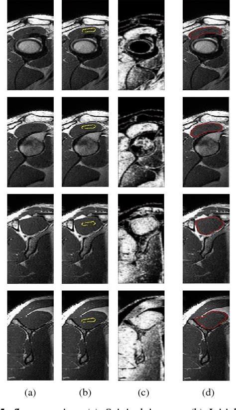 Figure 5 From Active Contour Segmentation Using Level Set Function With