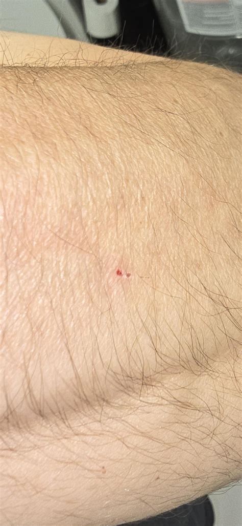 Possible Bat Bite R Healthadvice
