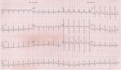 Bifascikulárna Blokáda Ekg Kniha Techmed