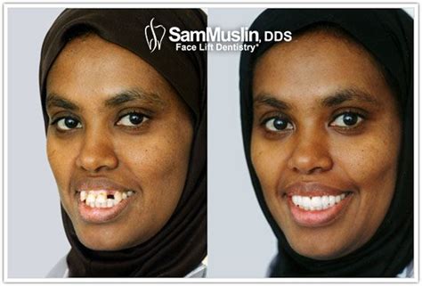 Braces Before And After Buck Teeth
