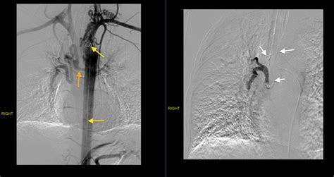 Bronchial Artery Embolization Radiology At St Vincents University Hospital
