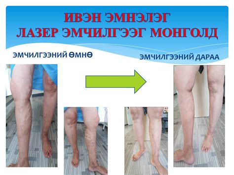 ИВЭН эмнэлэг Хөлийн судасны бүдүүрлийн ЛАЗЕР ЭМЧИЛГЭЭ