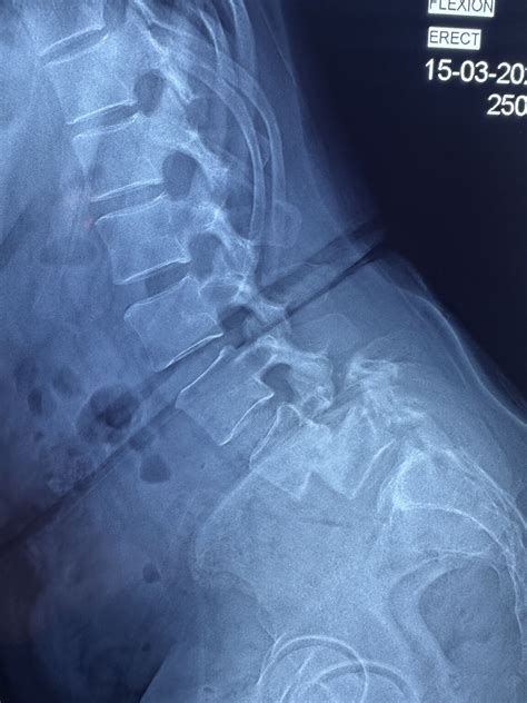 In Patients Who Present With High Grade Listhesis Decompression Of The