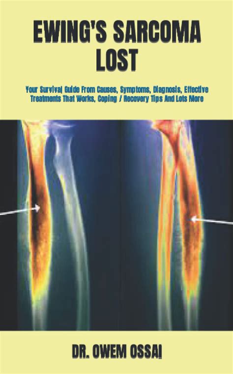 Ewings Sarcoma Lost Your Survival Guide From Causes Symptoms Diagnosis