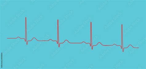 Ventricular Repolarization Cardiac Cycle Ecg Of Heart In Normal Sinus