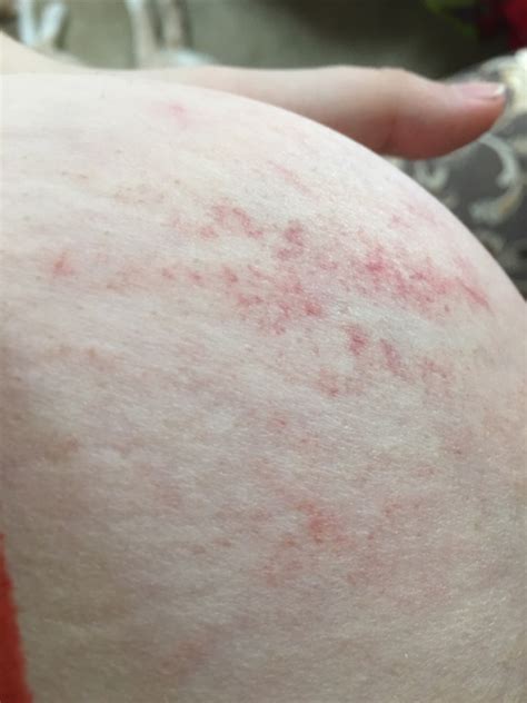 Purple Rash On Breast