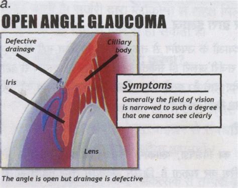 Open Angle Glaucoma Health Vision